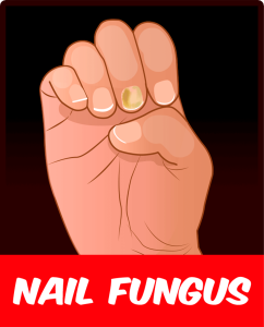Fungisol - The trusted fungal infection medicine in the Philippines.