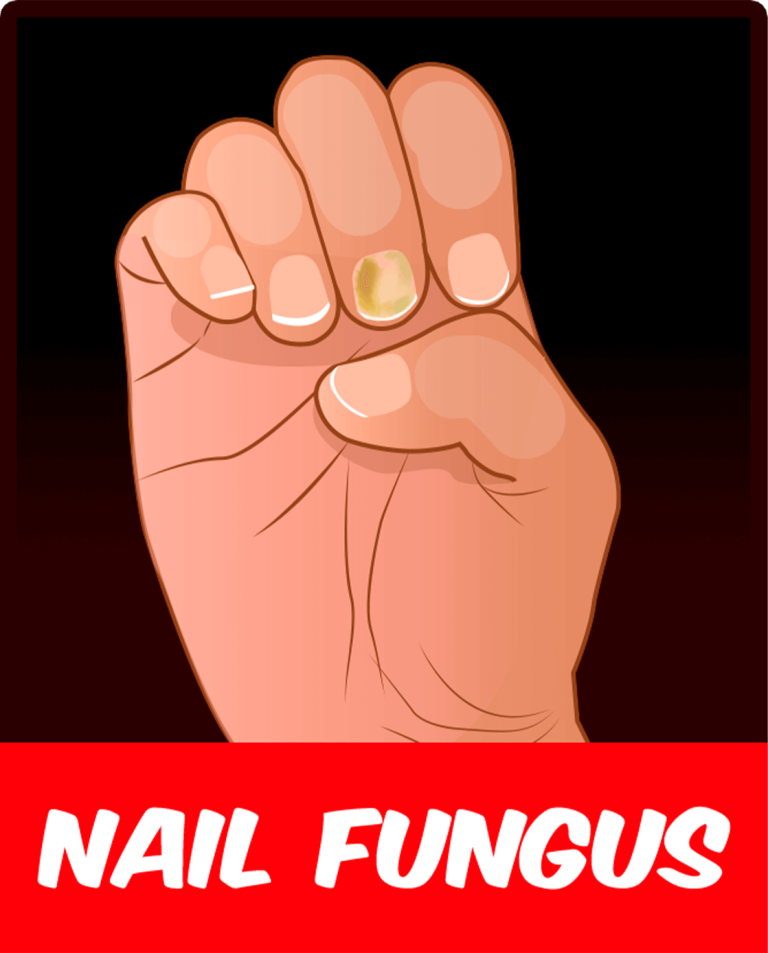 Fungisol - The trusted fungal infection medicine in the Philippines.
